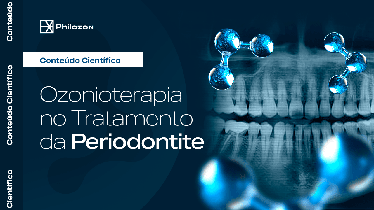 Ozonioterapia como adjuvante no tratamento da periodontite: abordagem inovadora para a saúde ...